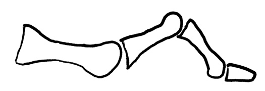 Hamertenen / klauwtenen - Rijnland Orthopaedie